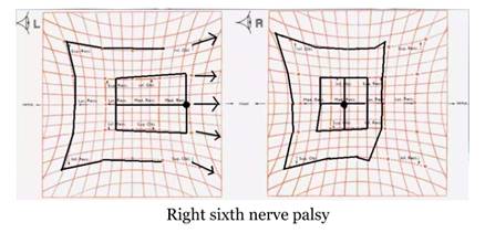 自製Hess Chart Lancaster Chart
