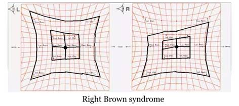 自製Hess Chart Lancaster Chart