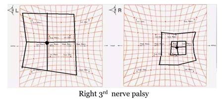 自製Hess Chart Lancaster Chart